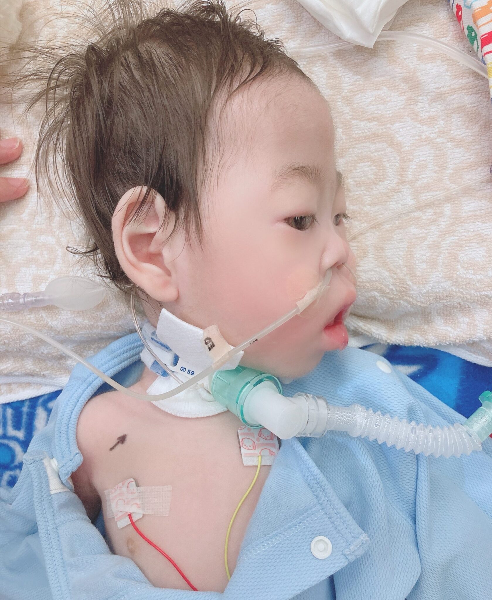 【中心静脈留置カテーテル】CV卒業したので総まとめ！ | ひつじマークのゆきとくん